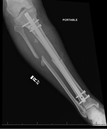 Proximal Third Tibia Fracture - Trauma - Orthobullets